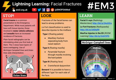 lightning learning facial fractures — em3