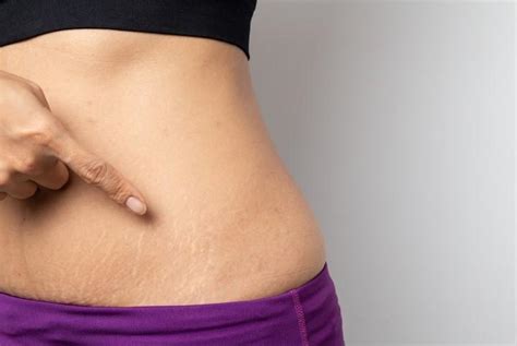 Guest Post Camouflage Tattoo Treating Scar Stretch Mark And Vitiligo