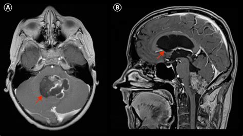 Ependymom Neurochirurgie Inselspital Bern