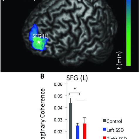 Posterior Cingulate Cortex Seeded Functional Connectivity Difference In