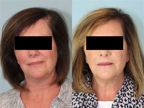 Hair Transplant Before And After 6 Jesse E Smith Md Facs Ft Worth