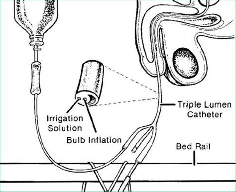 Continuous Bladder Irrigation