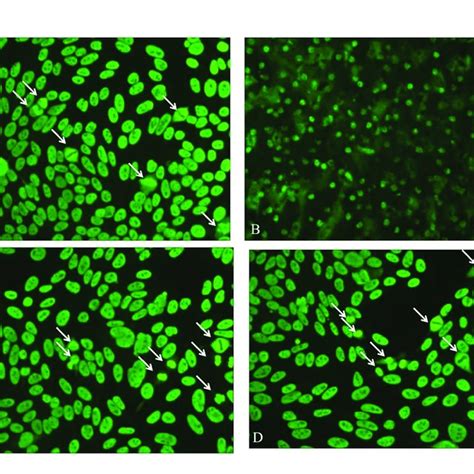 Immunofluorescence Patterns Of The 50 Year Old Dm Patient By Iif