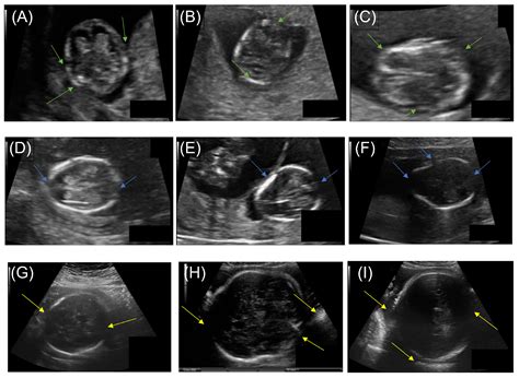Diagnostics Free Full Text Ensemble Transfer Learning For Fetal