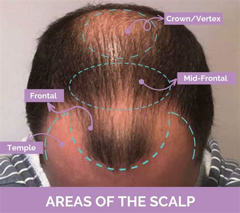Bald Spot On Crown Common Causes And Effective Treatments