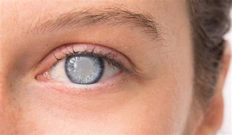 Cataract Surgery What To Expect Before During And Afterward David