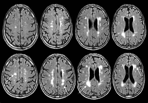 progression of cerebral white matter lesions in alzheimer s disease a