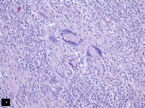 B High Power Photomicrograph Of Orchiectomy Specimen Demonstrating