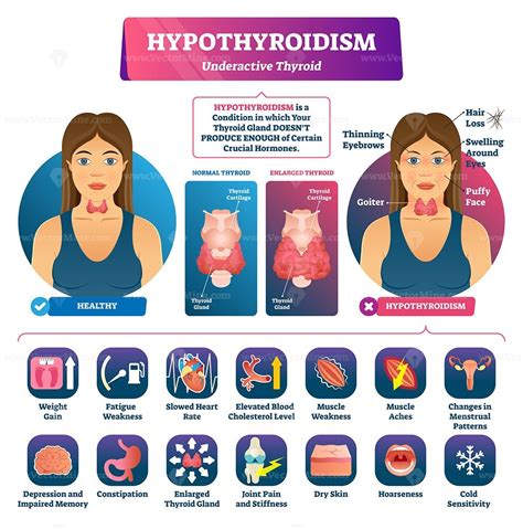 Hypothyroidism Vector Illustration Vectormine