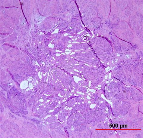 Pathology Outlines Adenomatoid Tumor