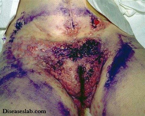 nasty blue waffle vagina mega porn pics