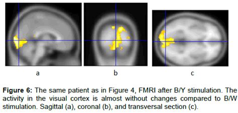 Clinical Experimental Ophthalmology Visual Cortex