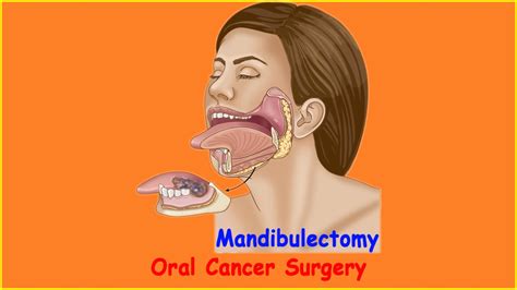 Oral Cancer Surgery Commando With Marginal Mandibulectomy And Neck
