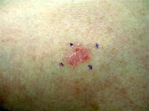 Hyperkeratotic Actinic Keratosis