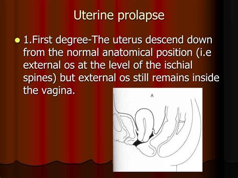 Ppt Genital Prolapse Powerpoint Presentation Id 737997