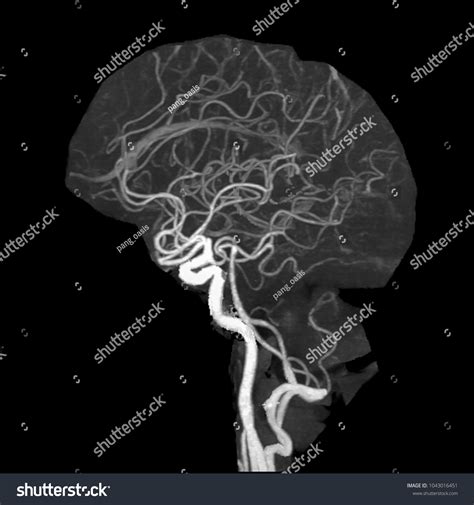 Lateral View Computed Tomography Angiography Cta Brain 库存照片（立即编辑