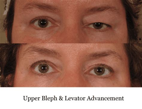 Upper Blepharoplasty Reston Va Rostami Opc