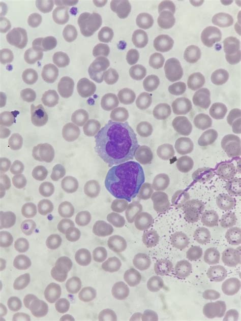 Atypical Lymphocyte Ebv