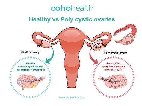 Female Hormone Problems Functional Medicine To The Rescue