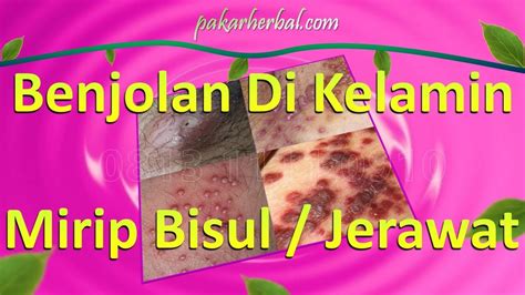 Ada Benjolan Di Kemaluan Wanita Menyerupai Bisul Kecil Atau Jerawat