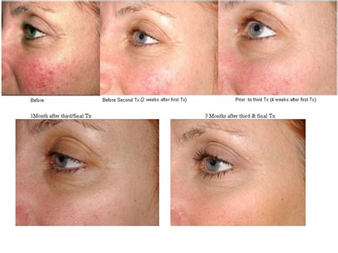 Rosacea Before And After