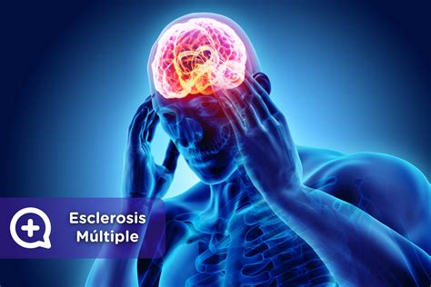 Esclerosis Múltiple Diagnóstico Síntomas Y Tratamiento Mediquo