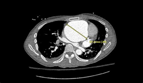 Computed Tomography Angiogram Cta Of The Chest And Abdomen Download
