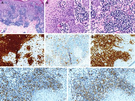 A The Punch Biopsy Of The Skin Lesion Shows A Dense Atypical Lymphoid