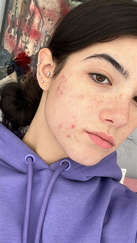 Charli ☆ Girl With Acne Pretty Skin Girl With Acne Aesthetic