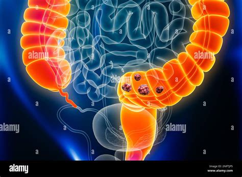Cancer Du Côlon Ou De Lintestin Grêle Avec Des Organes Et Des Tumeurs