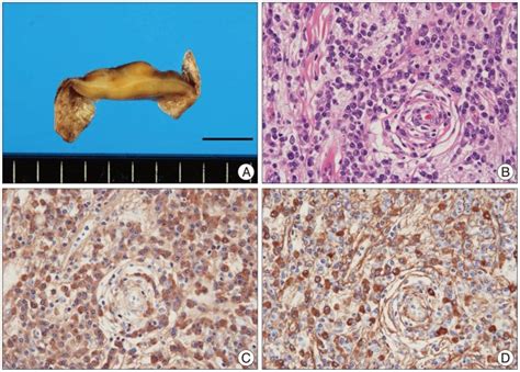 Pathological Findings A A Macroscopic Observation Shows A Solid
