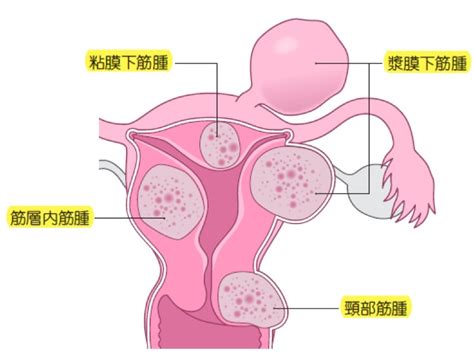 子宮筋腫について｜婦人科｜常磐病院｜福島県いわき市