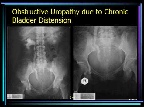 Ppt Bladder Outlet Obstruction In Women Powerpoint Presentation Free