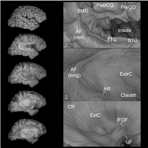Klingler Dissection Of The Arcuate Fasciculus As An Illustration The
