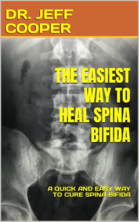 The Easiest Way To Heal Spina Bifida A Quick And Easy Way To Cure