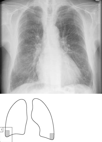 Pulmonary Edema Chf Chest X Ray