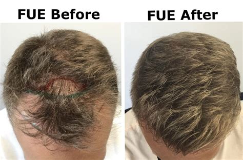 Fue Hair Transplant Prime Hair Transplant And Skin Clinic