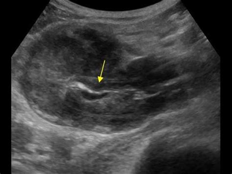 Abdomen And Retroperitoneum 1 8 Various Intra Abdominal Tumors Case