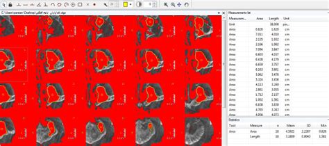Correlation Of The Maxillary Sinus Volume With Gender And Some Of