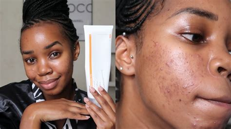 Acne Org Benzoyl Peroxide Tips For Clear Skin Youtube