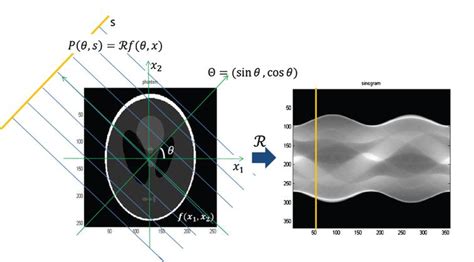 a ct metal artifact reduction algorithm based on sinogram surgery ios