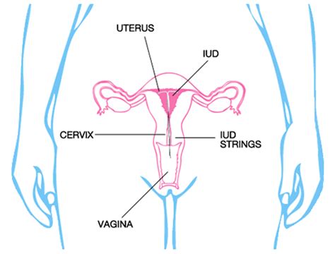 intrauterine device iud insertion warrandyte road