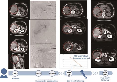 Role Of Transarterial Chemoembolization In The Treatment Of