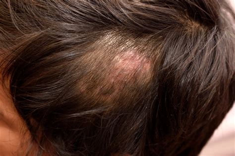 Fungal Skin Infections Types Symptoms And Treatment Bupa Uk