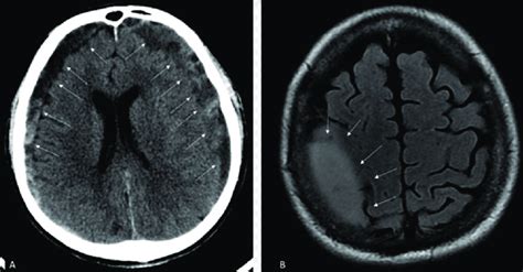 A Bilateral Frontoparietal Chronic Subdural Hematoma And B Right