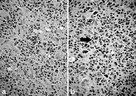A Pleomorphic Glial Cells With Hyperchromatic Nuclei And Atypical