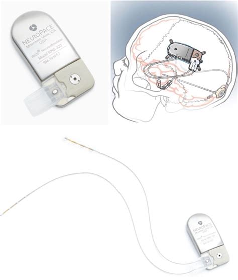 Neuromodulation In Drug Resistant Epilepsy