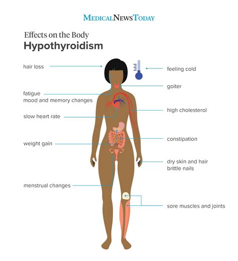 Hyperthyroidism Vs Hypothyroidism Chart