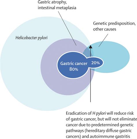 Is It Time To Screen And Treat H Pylori To Prevent Gastric Cancer