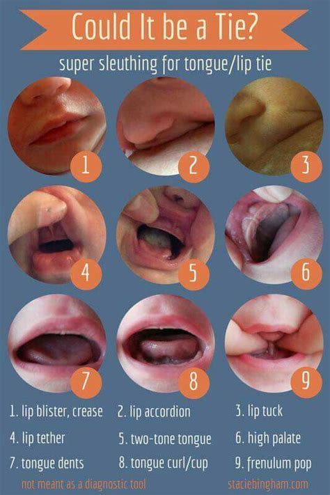 Lip And Tongue Ties Arent Always Obvious If You Are Struggling With